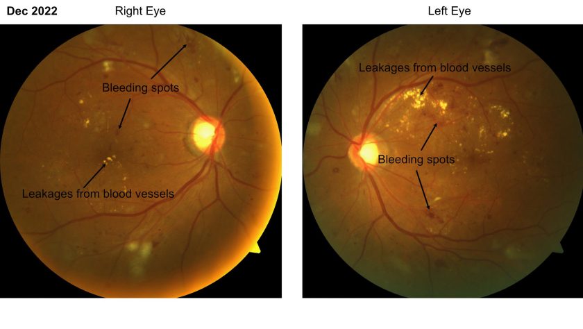 How can Diabetes affect your eyes? - Evershine Optical